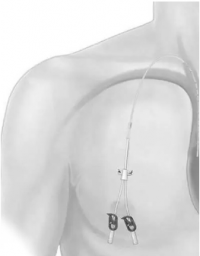 Hemodiálisis y diálisis peritoneal – FUNDACIÓN RENAL ESPAÑOLA